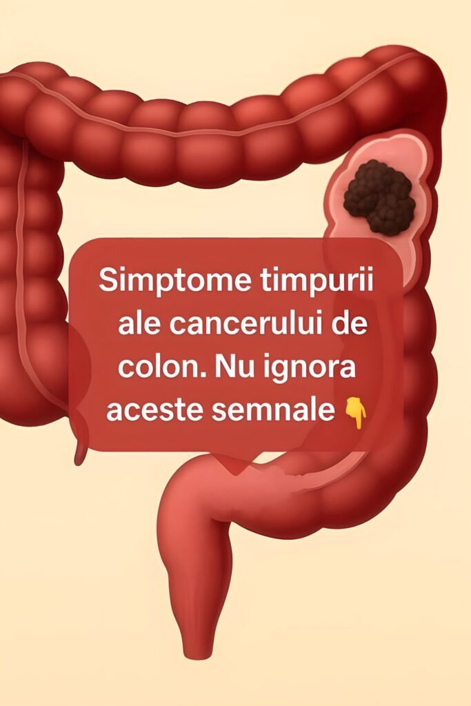 Simptome timpurii ale cancerului de colon – ora1.ro